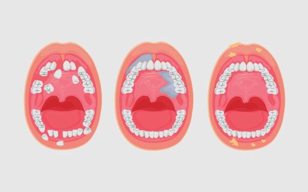 Oral Cancer – Types – Risk Factors – Symptoms – Diagnosis – Stages ...