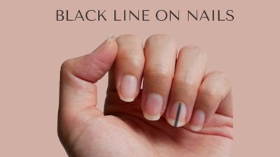 Spotting a Black Line on Nails and What it Signifies - VIMS