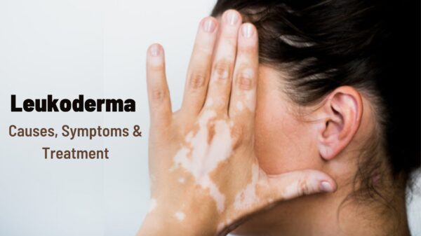 Leukoderma Causes, Symptoms and Treatment - VIMS