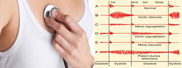 All you Need to Know About Murmur - VIMS