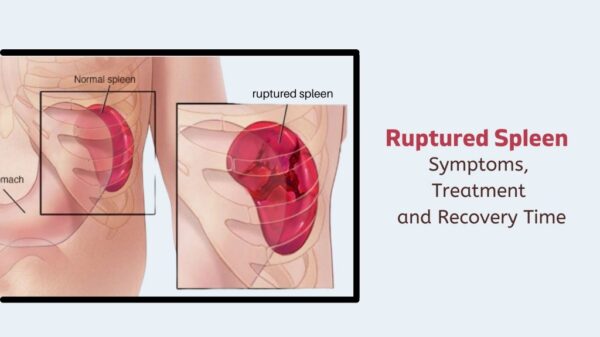 Ruptured Spleen Symptomstreatment And Recovery Time Vims