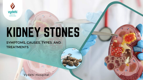 Kidney Stones: Symptoms, Causes, Types, and Treatments