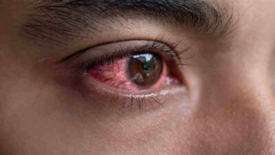 Eye Flu Treatment: Symptoms, Causes, and Home Remedies