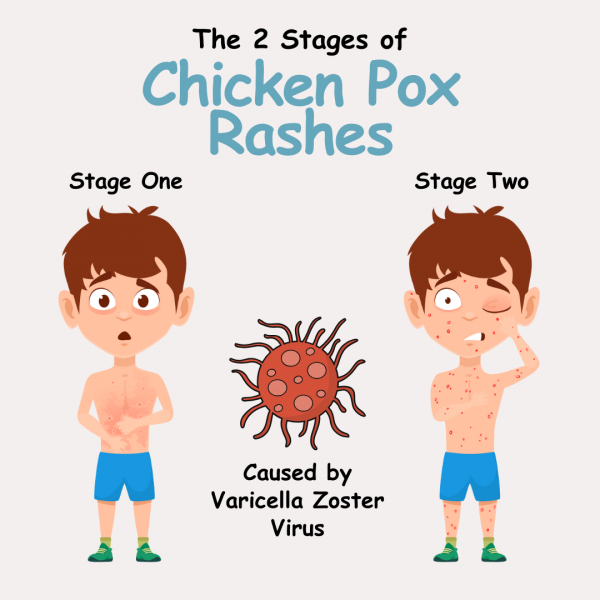 Myths: Separating Fact from Fiction About Chicken Pox | VIMS&RC